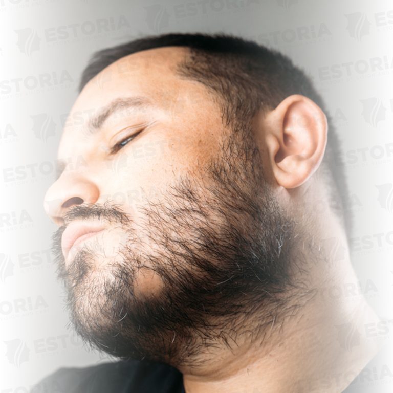 Mustache Transplantation - Private Estoria Polyclinic